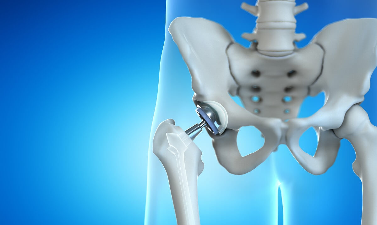 Direct Anterior Approach Hip Replacement - Professor Ali Ghoz