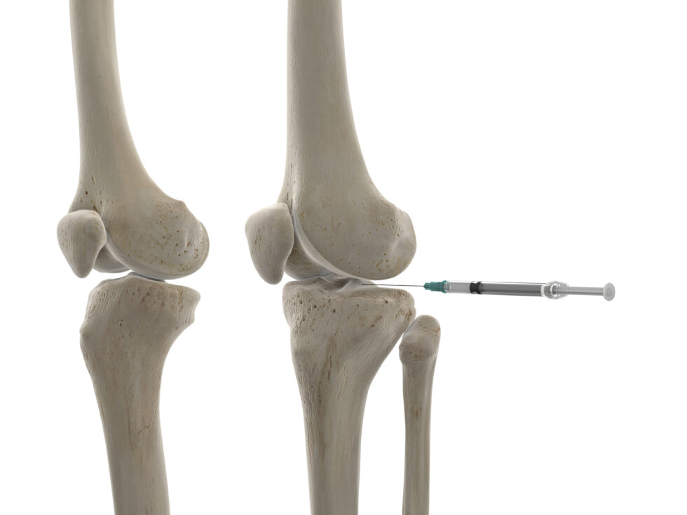 Is Arthrosamid Safe? Risks, Side Effects, and What to Expect ...